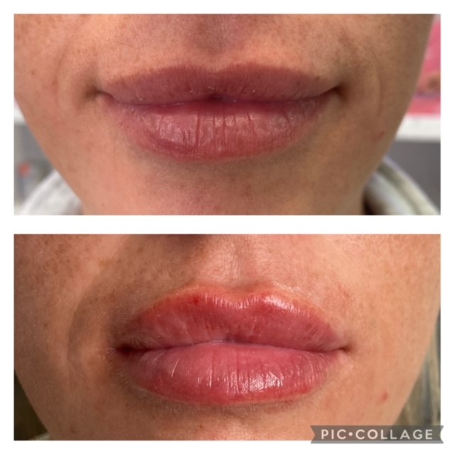 Injectables - Botox, Fillers, PRF